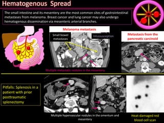 The Wheel of the Mesentery.pptx