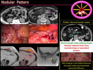The Wheel of the Mesentery.pptx