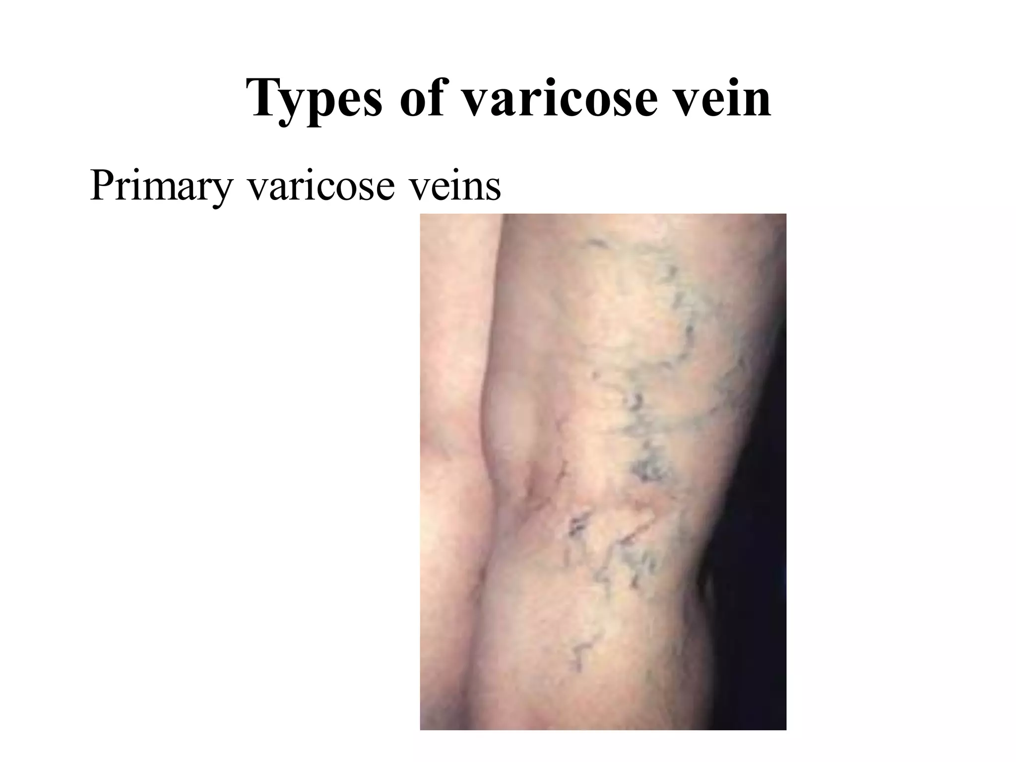 THE WHITE ARMY-VARICOSE VEINS.pdf