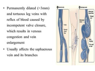 THE WHITE ARMY-VARICOSE VEINS.pdf