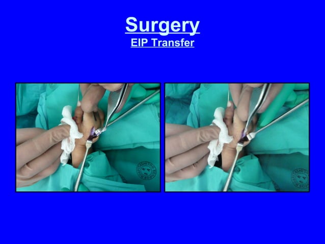 The windblown hand | PPT