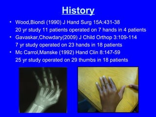 The windblown hand | PPT