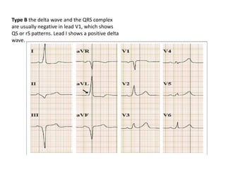 THE WOLFF–PARKINSON–WHITE.pptx