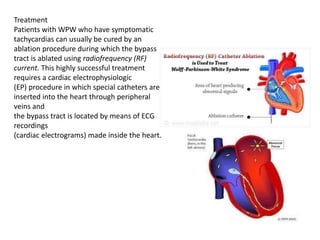 THE WOLFF–PARKINSON–WHITE.pptx