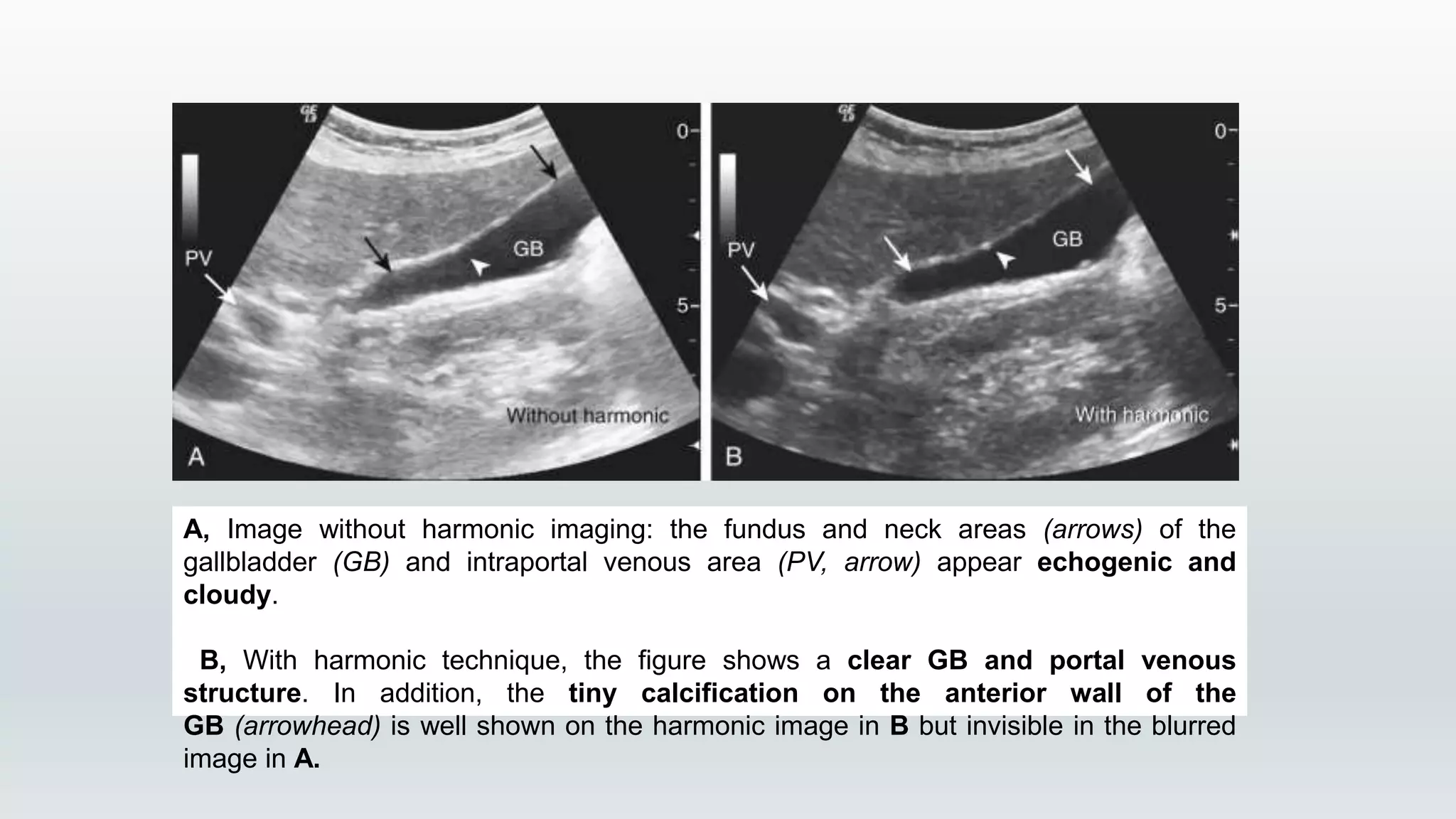 Tissue harmonic imaging | PPTX