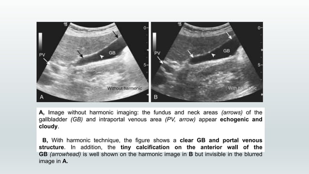 Tissue harmonic imaging | PPTX | Digital Audio | Computer Software and ...