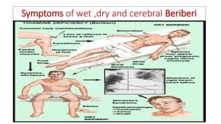 Dry Beriberi