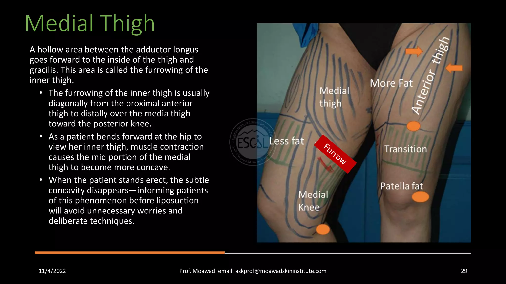 Thighs, Knees, and Lower Legs Liposuction.pptx