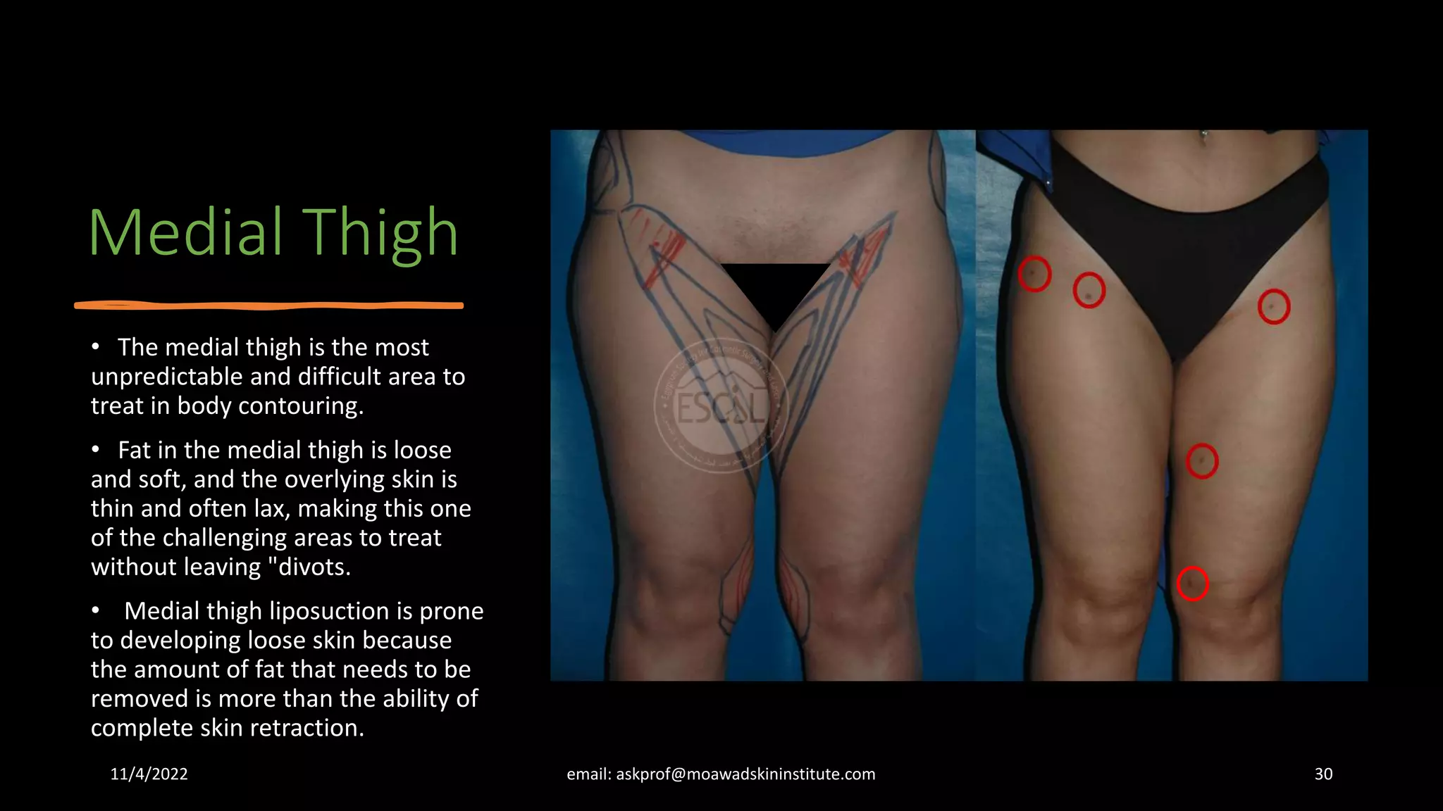 Thighs, Knees, and Lower Legs Liposuction.pptx