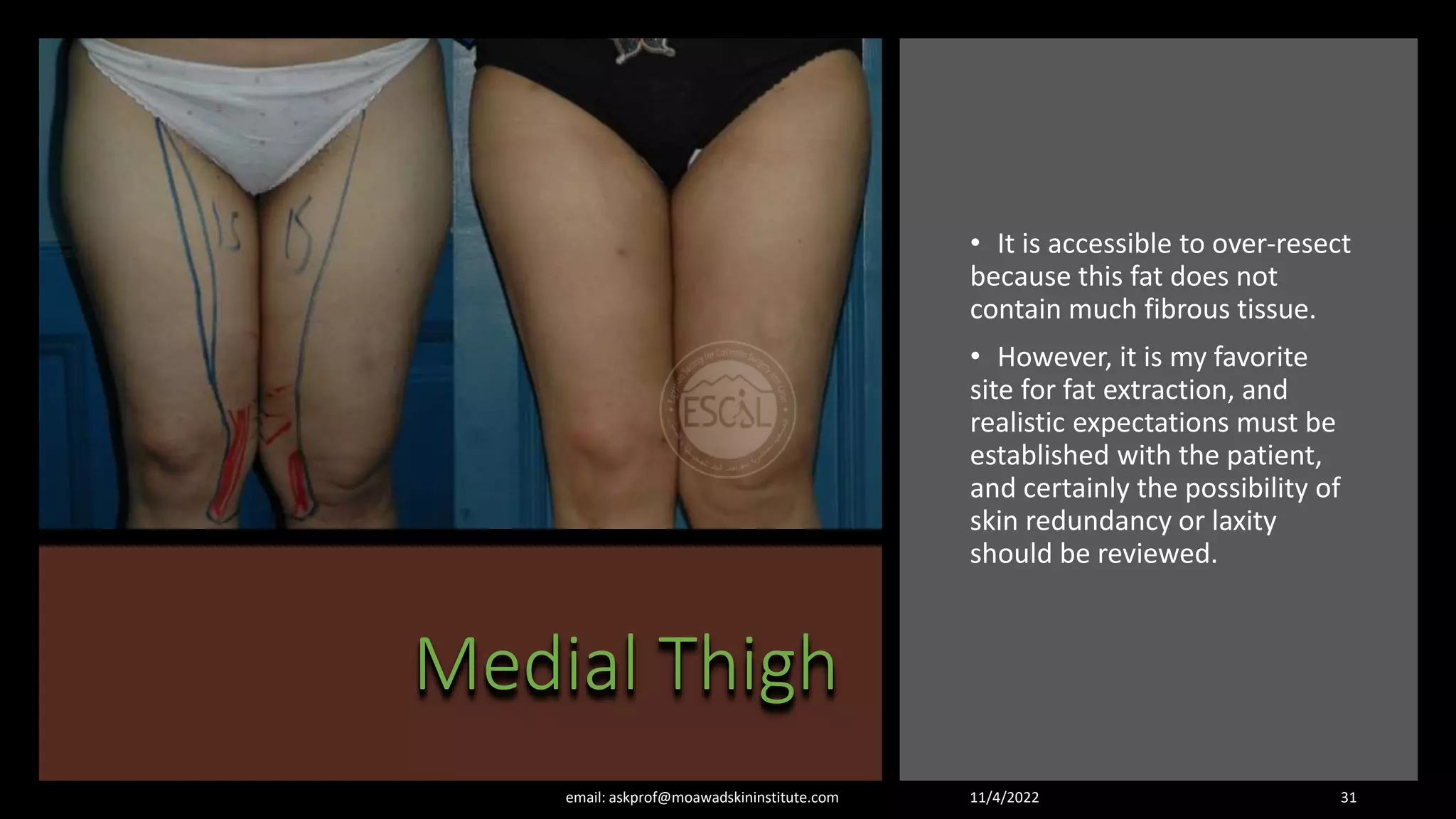 Thighs, Knees, and Lower Legs Liposuction.pptx