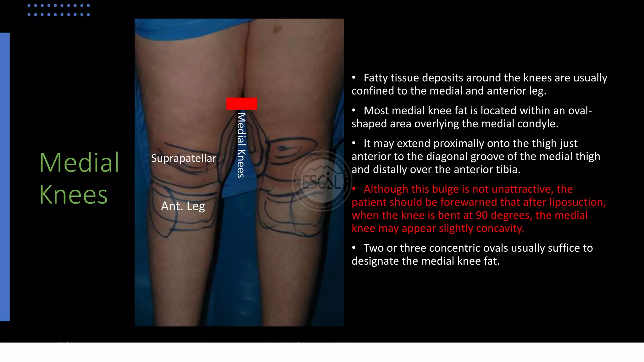 Thighs, Knees, and Lower Legs Liposuction.pptx