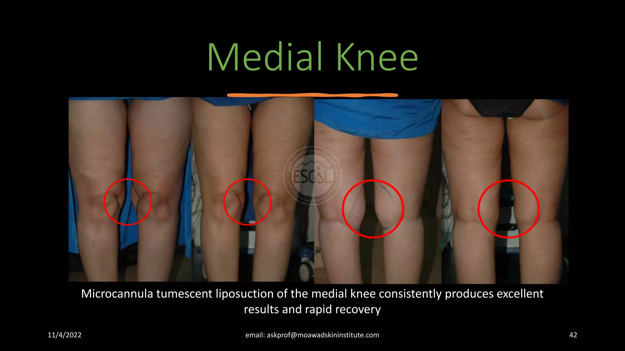 Thighs, Knees, and Lower Legs Liposuction.pptx