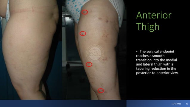 Thighs, Knees, and Lower Legs Liposuction.pptx