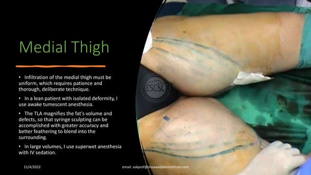 Thighs, Knees, and Lower Legs Liposuction.pptx