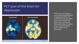 DEPRESSION | PPT