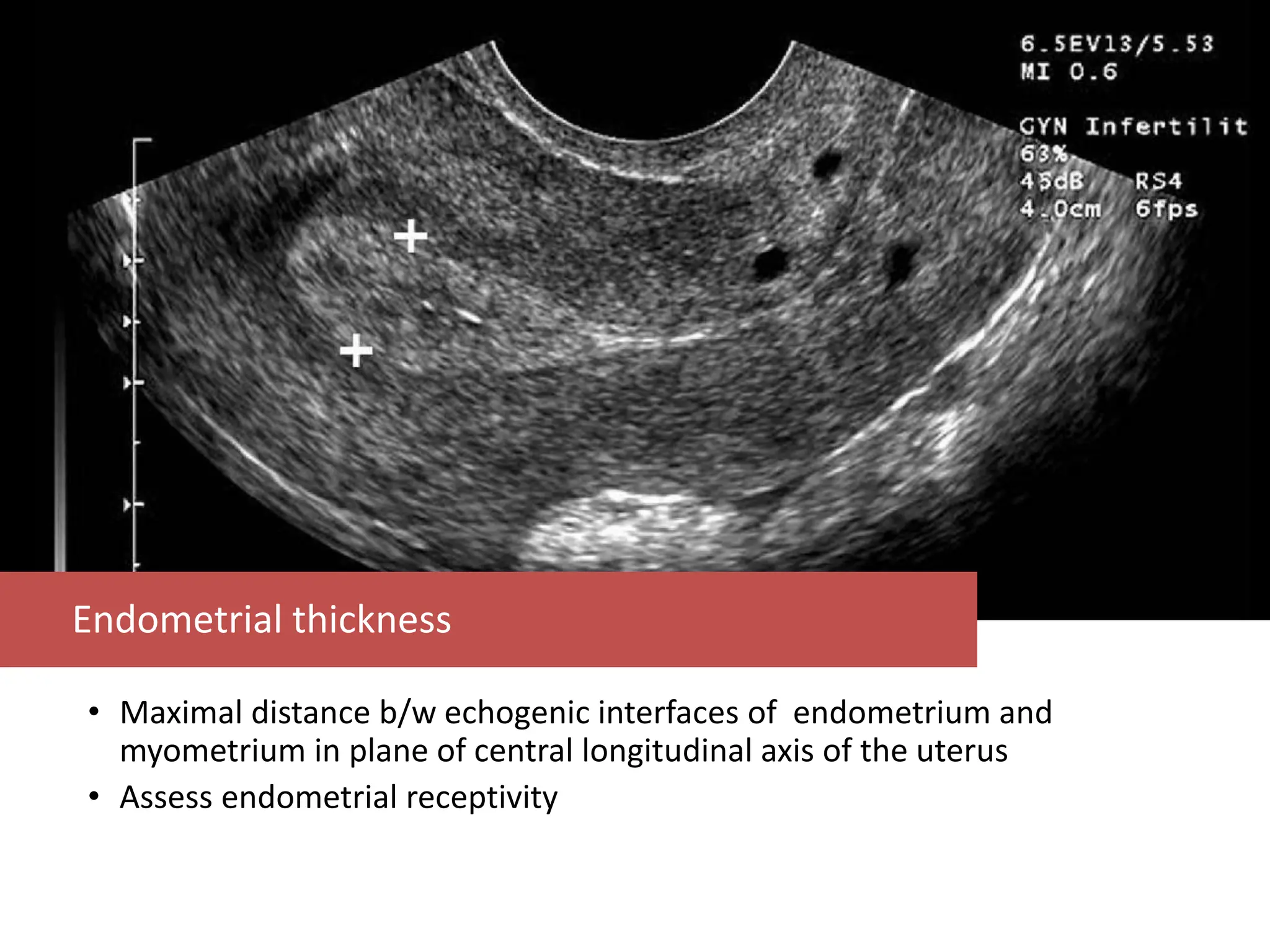 The Thin endometrium- Where are we today? | PPTX
