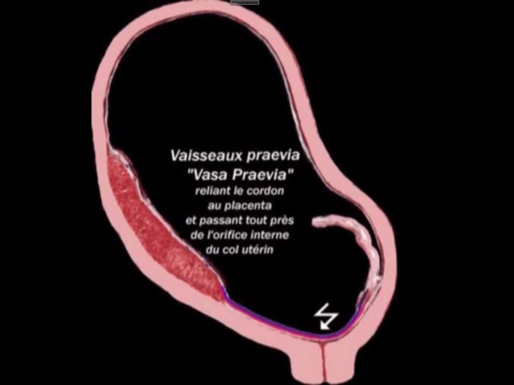 Third Trimester Bleeding third-trimester-bleeding
