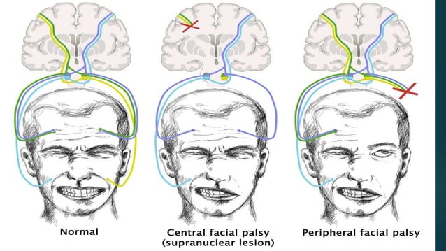 physiology of trigeminal nerve, UMNL& LMNL facial paralysis, taste | PPT