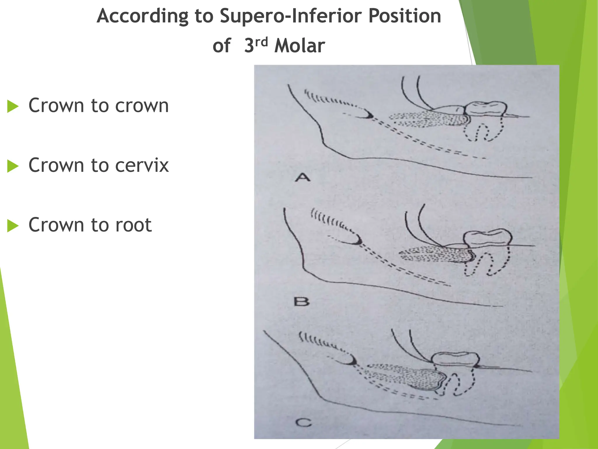 THIRD MOLAR IMPACTed tooth , development & Surgical complications.pptx