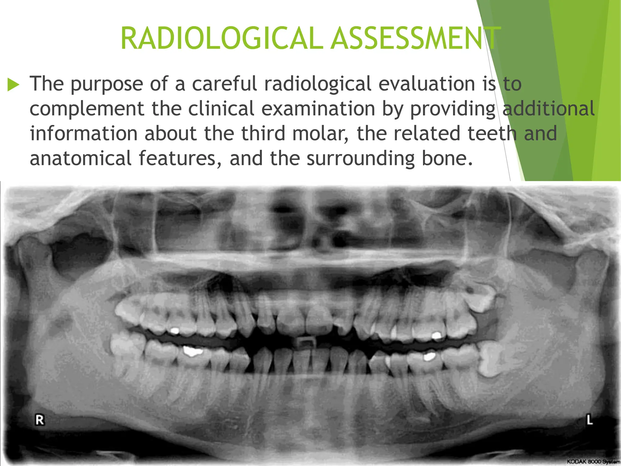 THIRD MOLAR IMPACTed tooth , development & Surgical complications.pptx