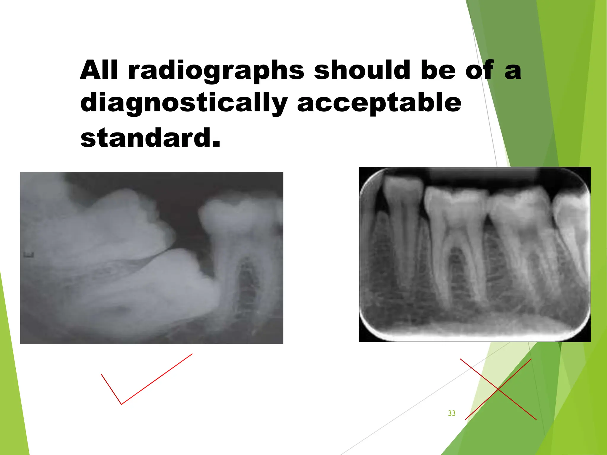 THIRD MOLAR IMPACTed tooth , development & Surgical complications.pptx