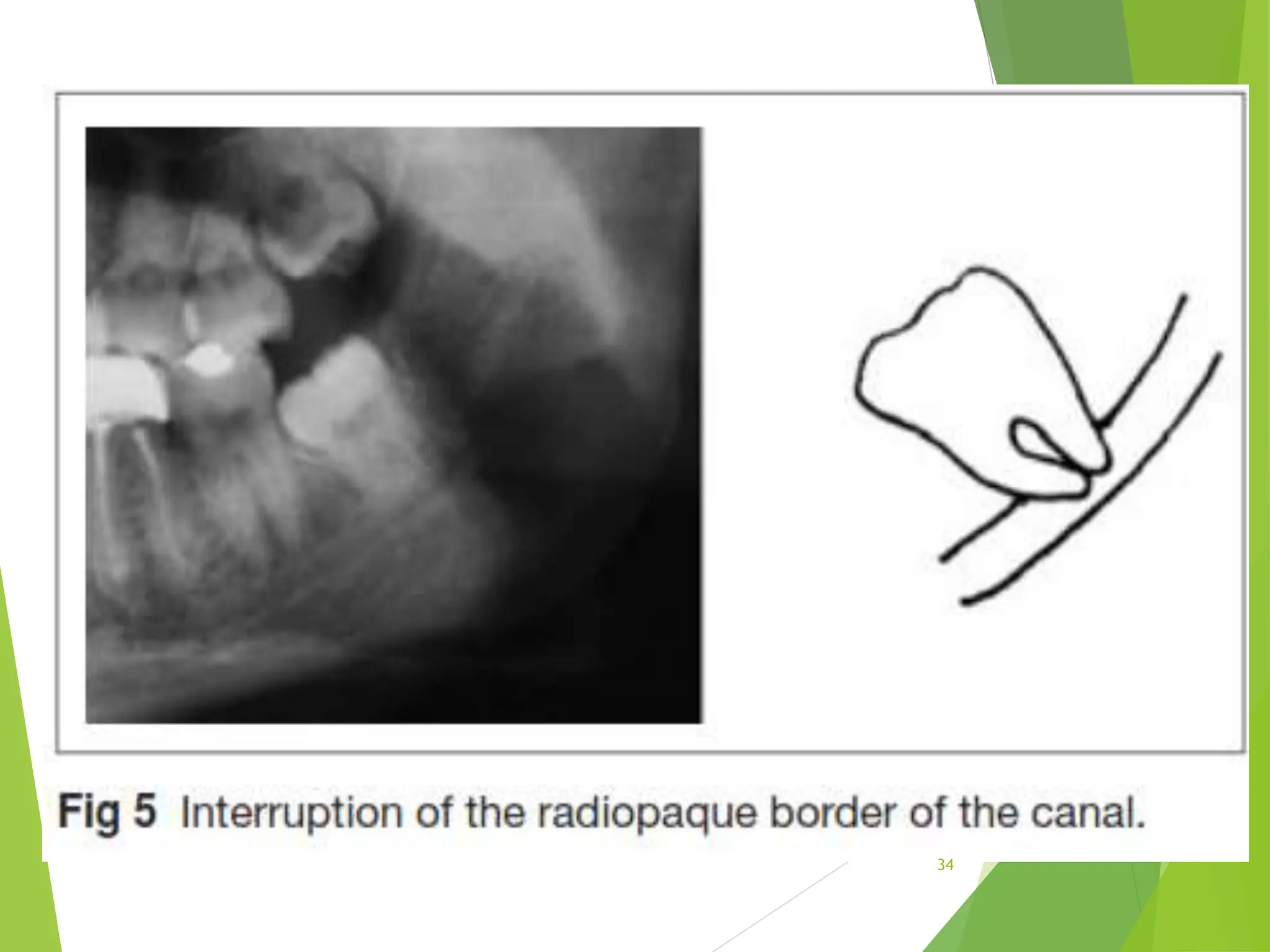 THIRD MOLAR IMPACTed tooth , development & Surgical complications.pptx