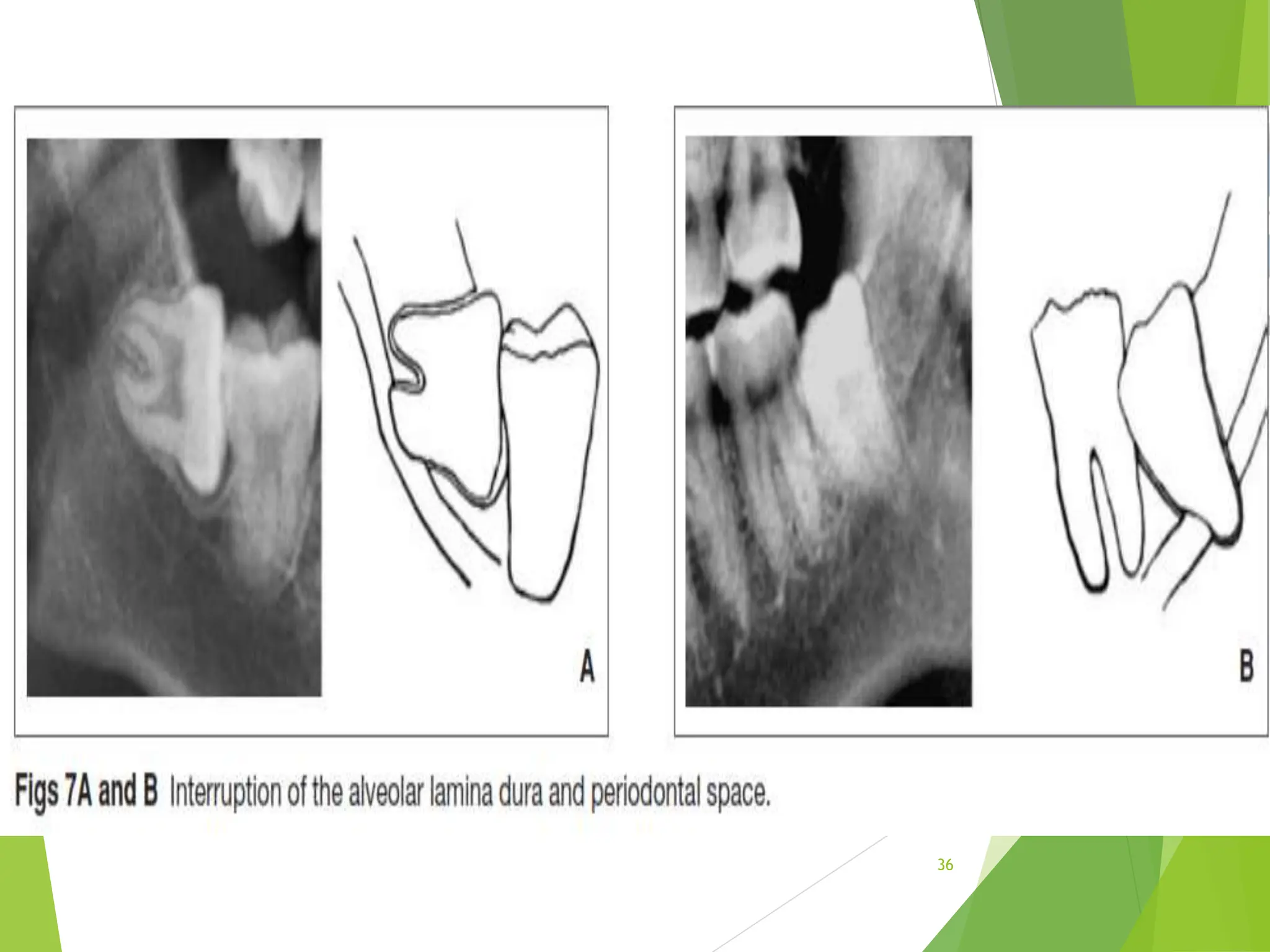 THIRD MOLAR IMPACTed tooth , development & Surgical complications.pptx