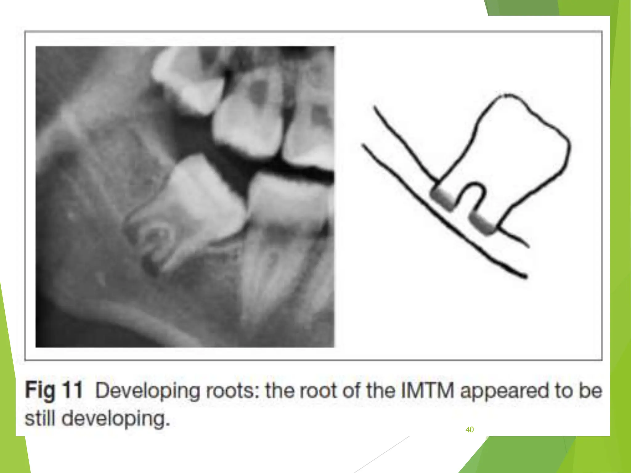 THIRD MOLAR IMPACTed tooth , development & Surgical complications.pptx