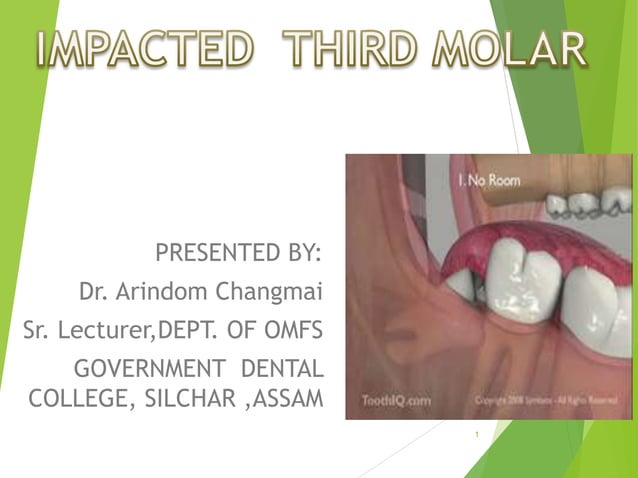 THIRD MOLAR IMPACTed tooth , development & Surgical complications.pptx