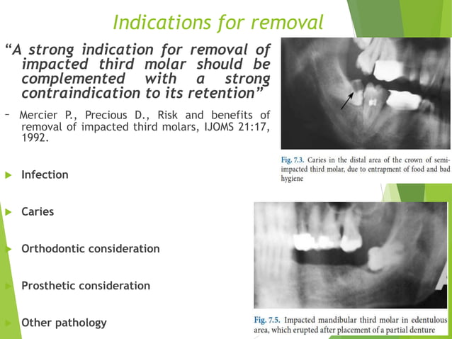 THIRD MOLAR IMPACTed tooth , development & Surgical complications.pptx