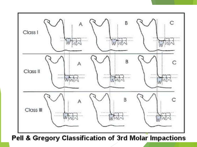 THIRD MOLAR IMPACTed tooth , development & Surgical complications.pptx