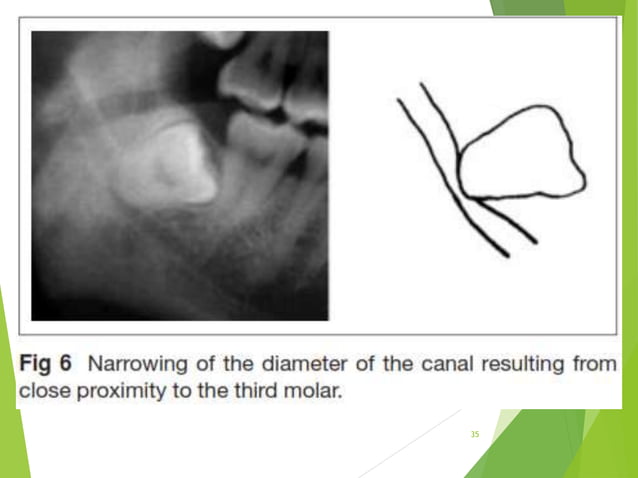 THIRD MOLAR IMPACTed tooth , development & Surgical complications.pptx