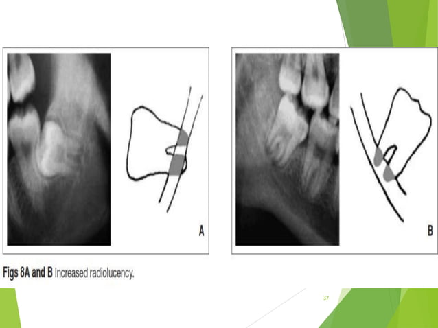THIRD MOLAR IMPACTed tooth , development & Surgical complications.pptx