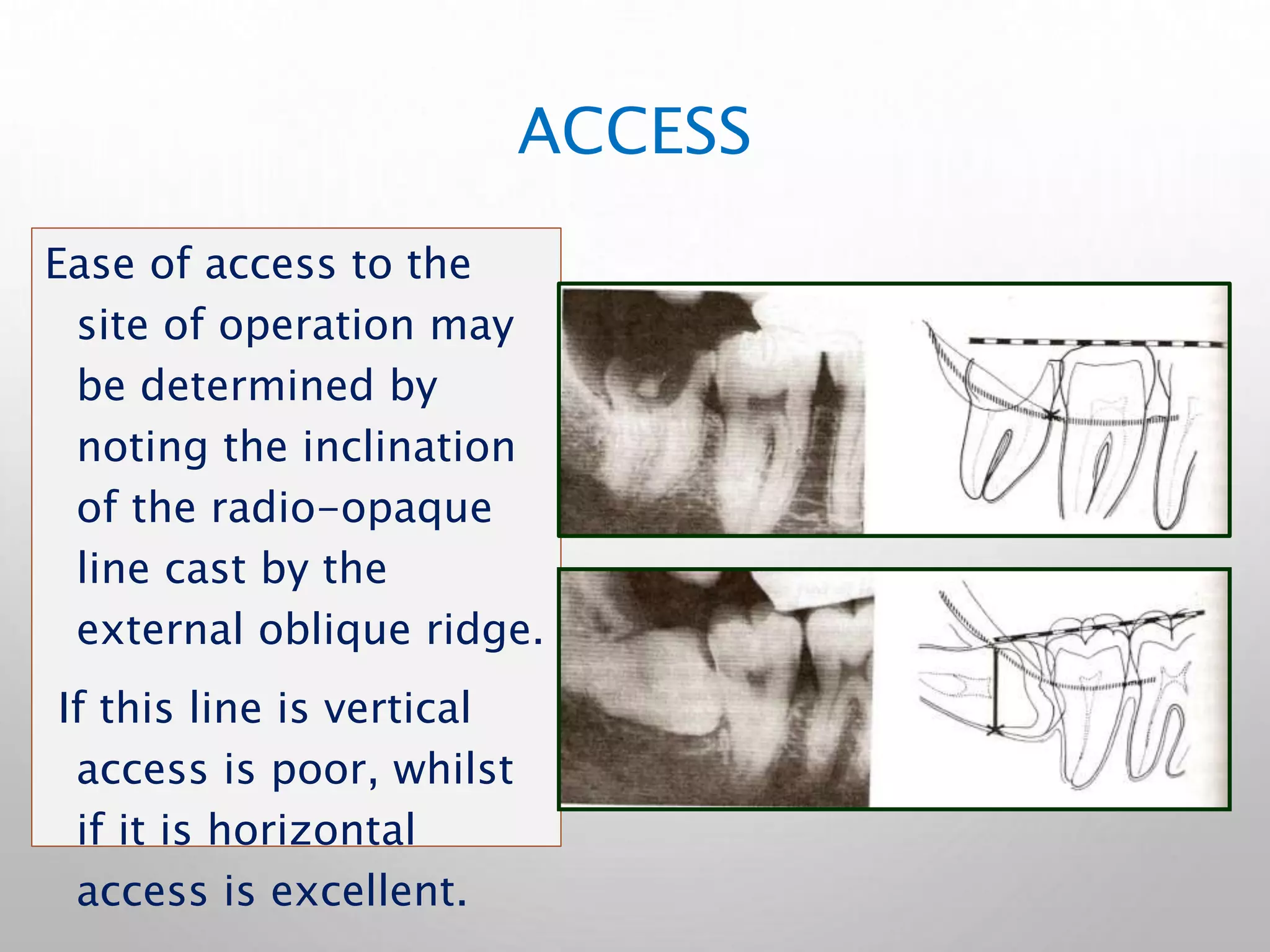 Third molar surgery | PPTX