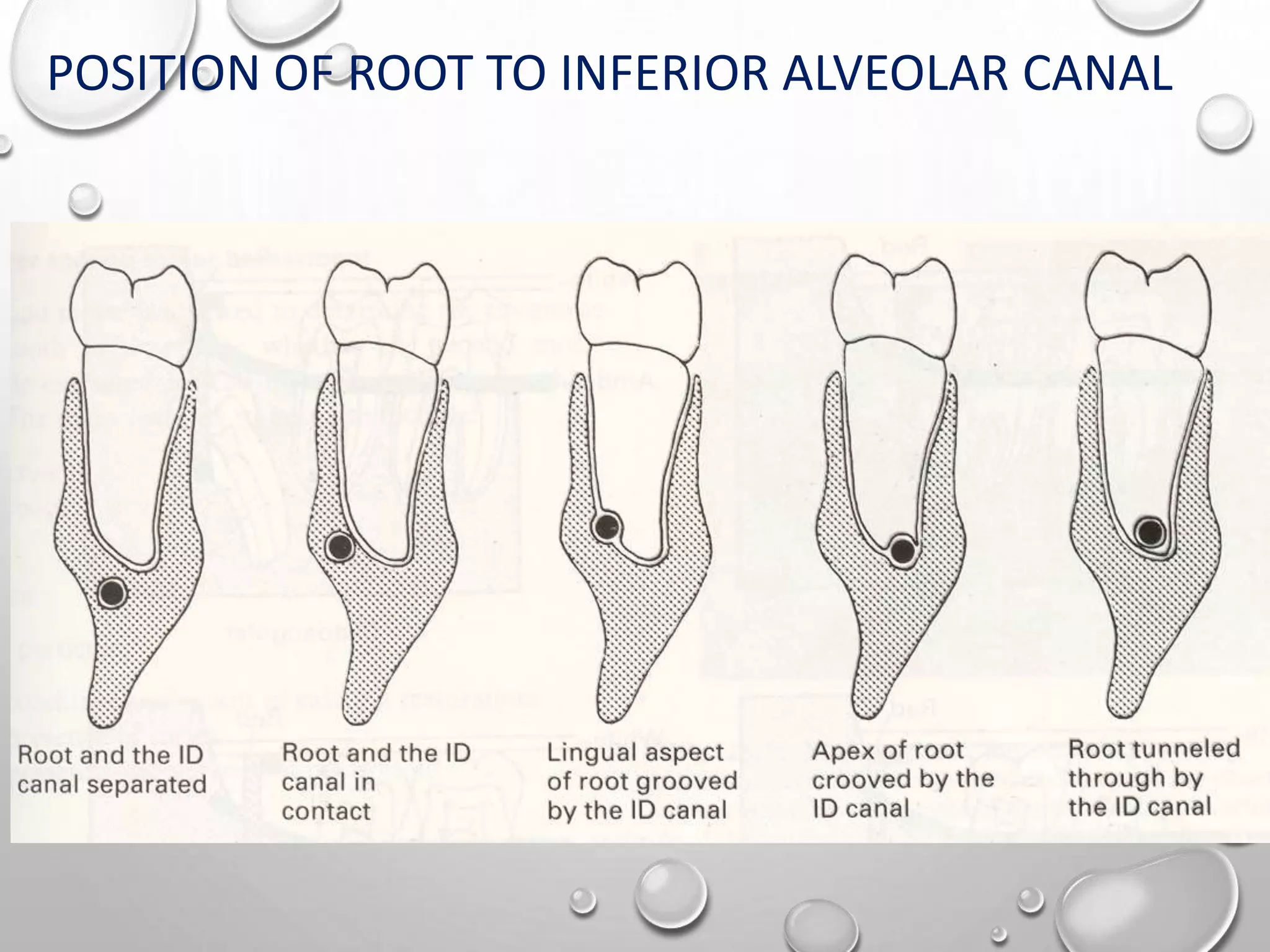 Third molar surgery | PPTX