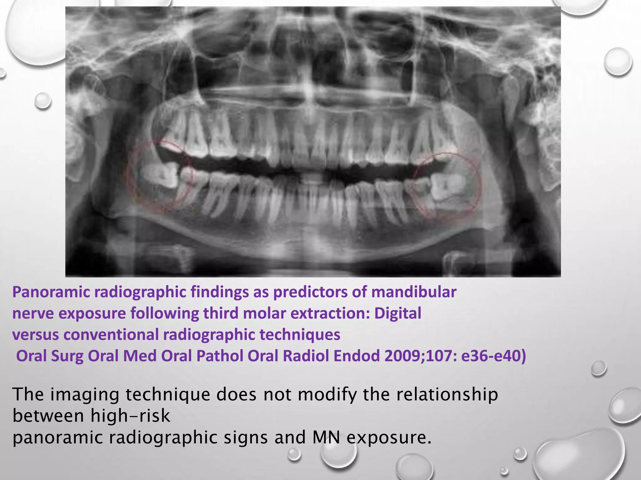 Third molar surgery | PPTX
