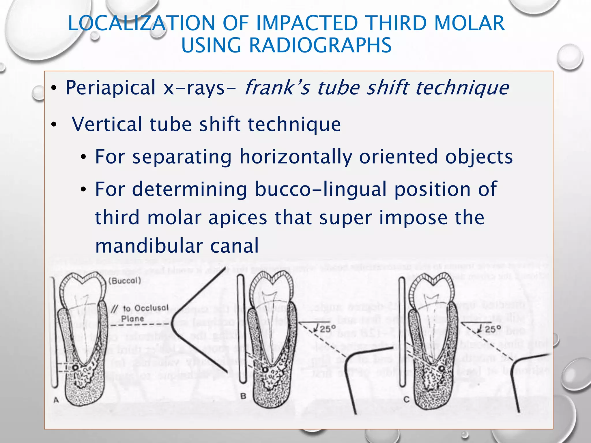 Third molar surgery | PPTX