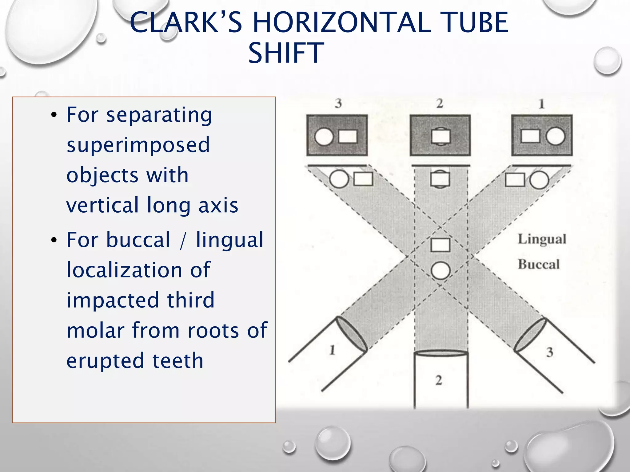 Third molar surgery | PPTX