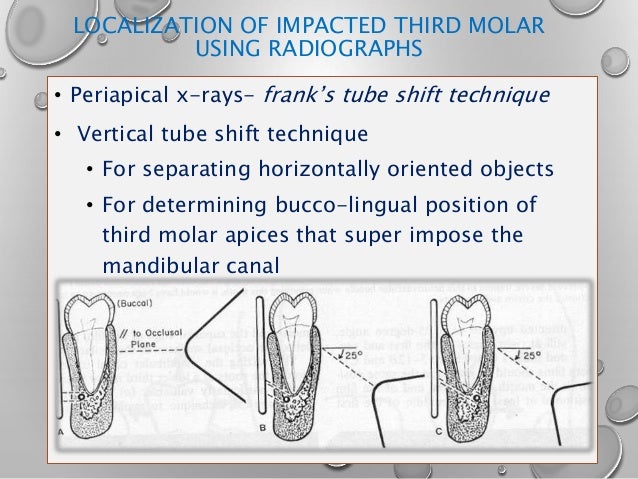 Third molar surgery