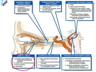 Case presentation: Third nerve palsy | PPT