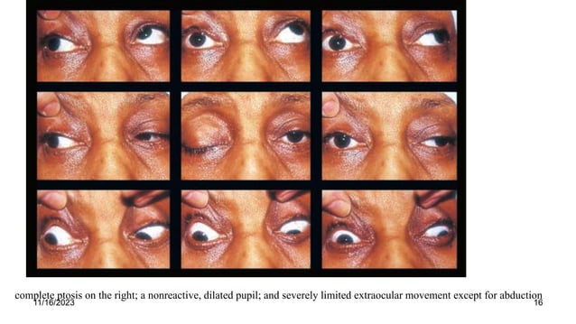 Third nerve palsy.pptx
