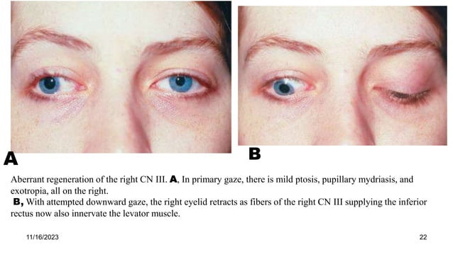 Third nerve palsy.pptx