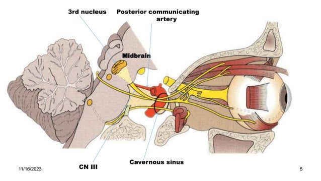 Third nerve palsy.pptx