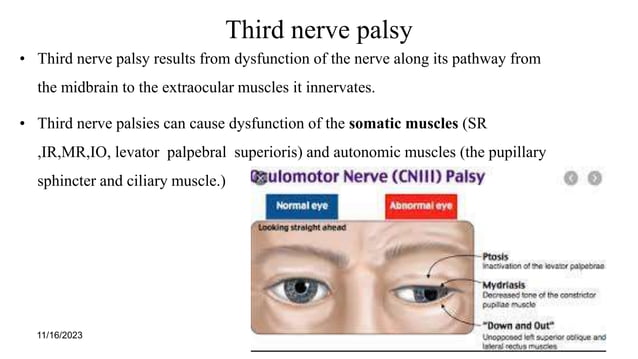 Third nerve palsy.pptx