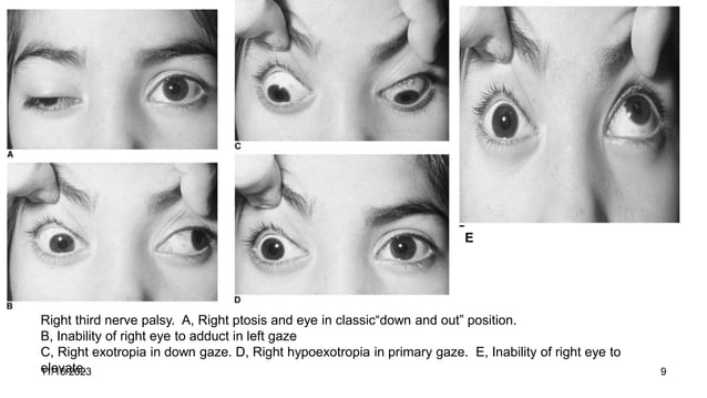 Third nerve palsy.pptx