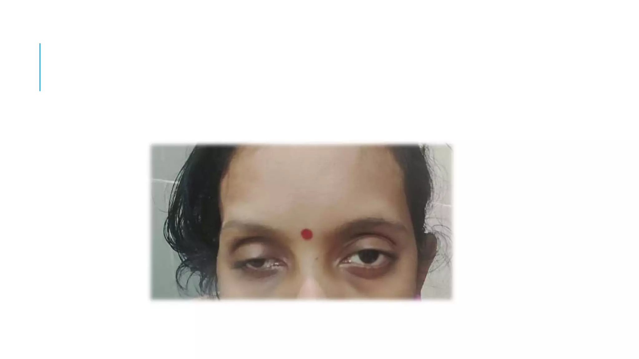 THIRD NERVE PALSY CASE PRESENTATION 2.pptx