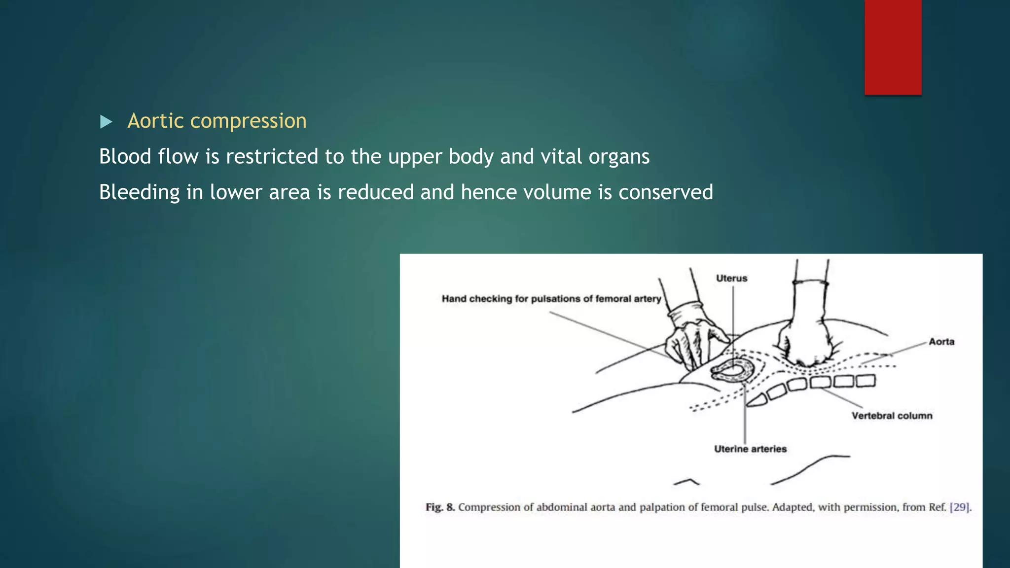 Third stage complications of labour- post partum hemorrhage in ...