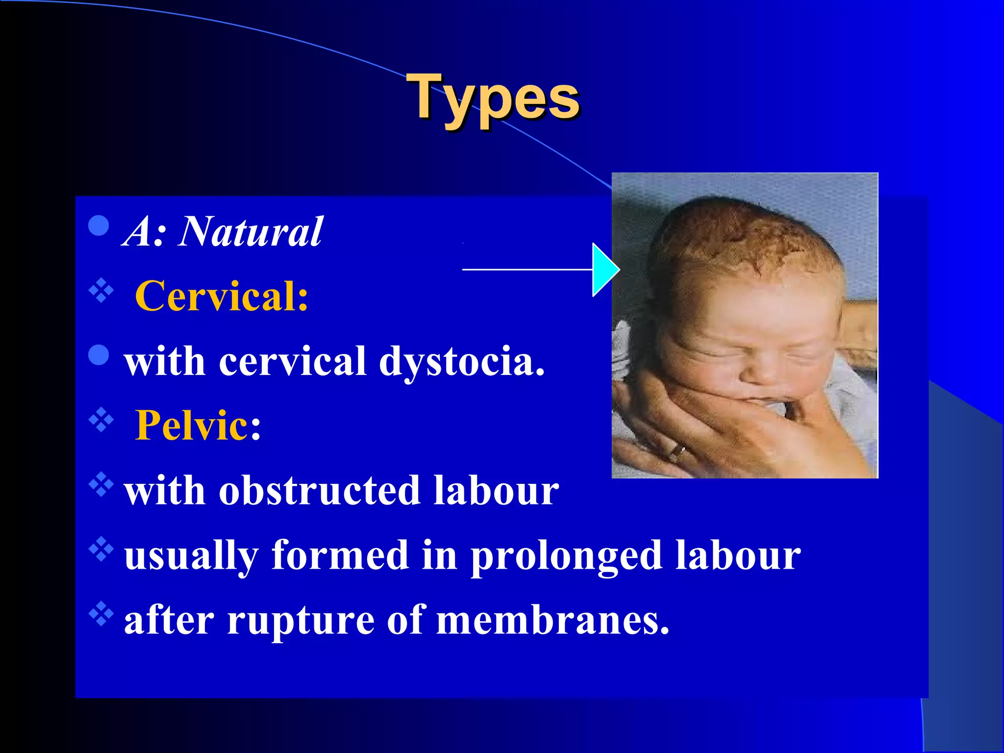 Third stage of labor for undergraduate | PPT