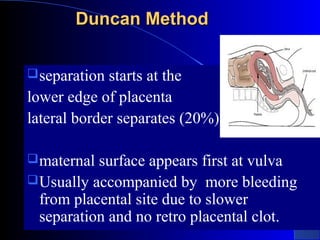 Third stage of labor for undergraduate | PPT