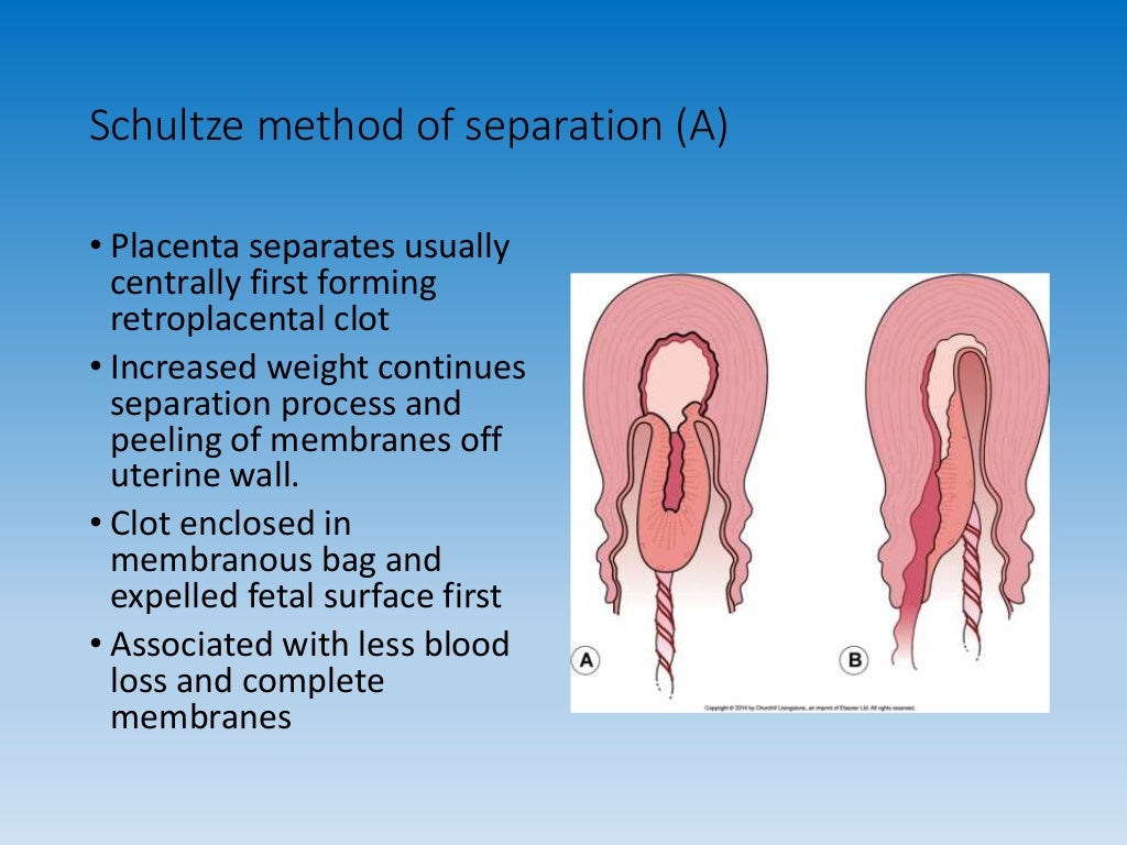 Third stage of labour